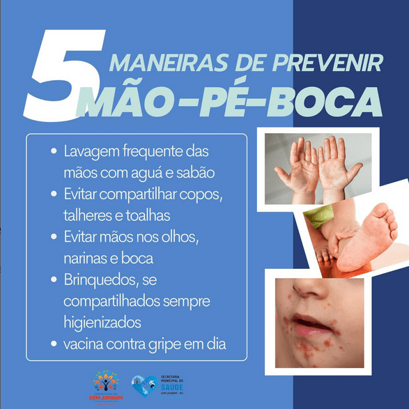 A Síndrome do pé mão e boca é uma doença causada por um vírus infantil ...
